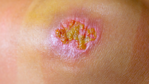 Qu'est-ce qu'une plaie exsudative et comment la traiter ? - Ma Cicatrice